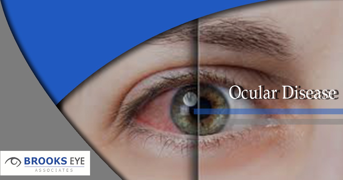 Types Of Ocular Surface Disease Brooks Eye Associates