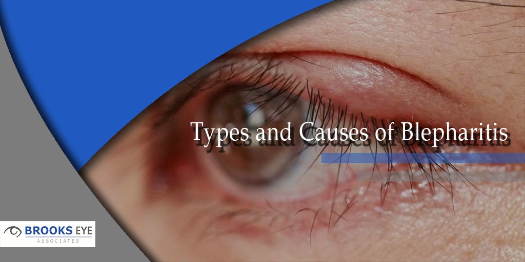 Staphylococcal Blepharitis