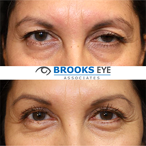 Eyelid Surgery | Brooks Eye Associates